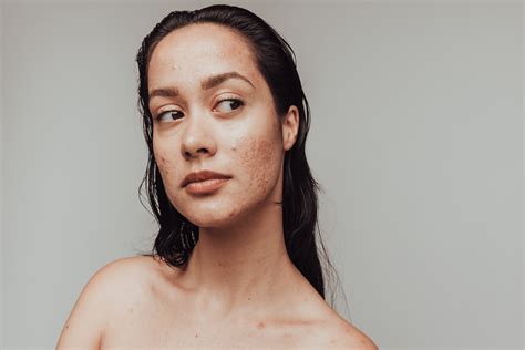 Acne Da Mulher Adulta