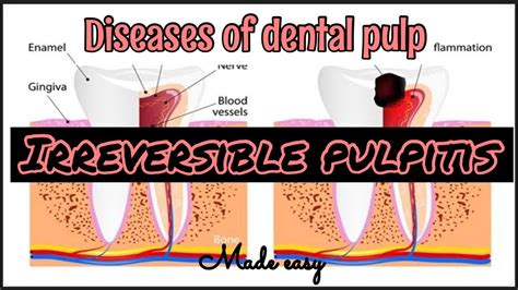 IRREVERSIBLE PULPITIS II INFLAMMATION OF PULP II DISEAES OF PULP II