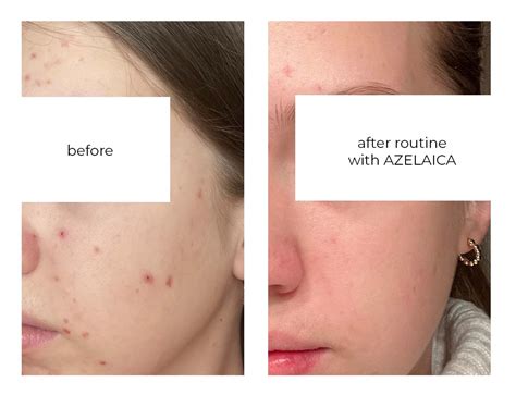 AZELAICA Skin Clearing Azelaic Acid Moisturizer 30ml Miss Alice