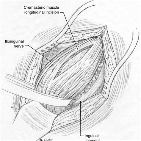 8 Learning Curve Of Robotic Inguinal Hernia Repair R TAPP In The