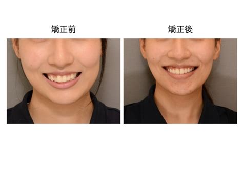 スタッフの歯列矯正まとめ 後編 星ヶ丘矯正歯科 名古屋市のワイヤーとマウスピースによる歯列矯正