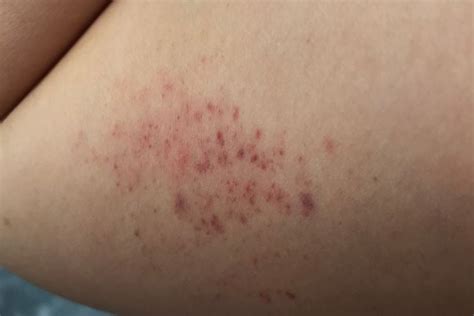 What Are The Types Of Bruises You Should Know About Facty Health