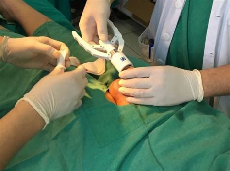 Cắt bao quy đầu là gì Tại sao phải cắt bao quy đầu