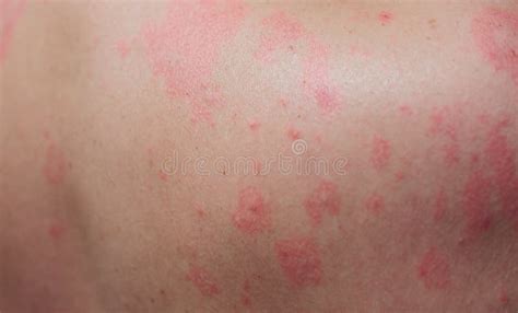 Close Up Allergy Rash Around Back View Of Human With Dermatitis