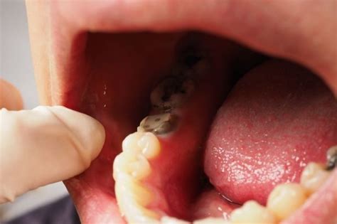 Por qué es necesario realizar una endodoncia en el diente coronado