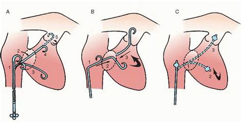 Pulmonary Angiography Thoracic Key