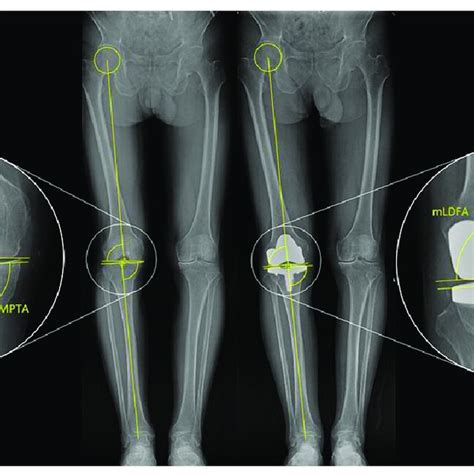 Measurement Of The Preoperative A And Postoperative B Joint Line