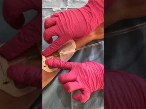 Colocación y retiro del catéter venoso periférico YouTube Cordon