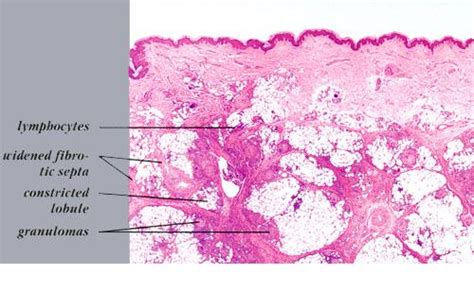 Erythema Nodosum Histology