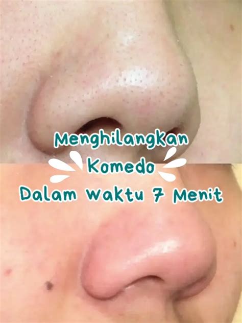 Menghilangkan Komedo Dalam 7 Menit Aja Video Dipublikasikan Oleh