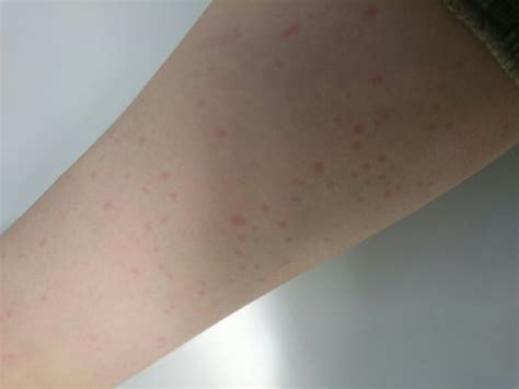 腕 に 赤い 斑点 かゆく ない 皮膚の赤い斑点は病気？かゆみがあるなしでの7つの原因と対処法！