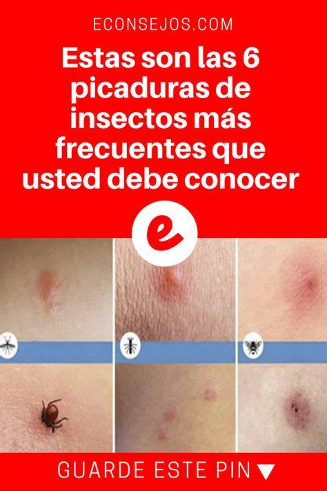 Tipos De Picaduras De Insectos Estas Son Las Picaduras De Insectos