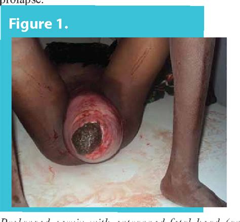 Slight Vaginal Prolapse