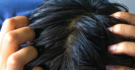 Alopecia cicatricial Qué es causas y síntomas