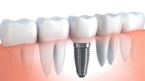 Implante Dentário conheça os principais tipos Dr Augusto Fernandes