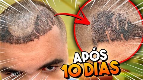 Fios de Sustentação Para o Rosto Como Funciona Este Procedimento