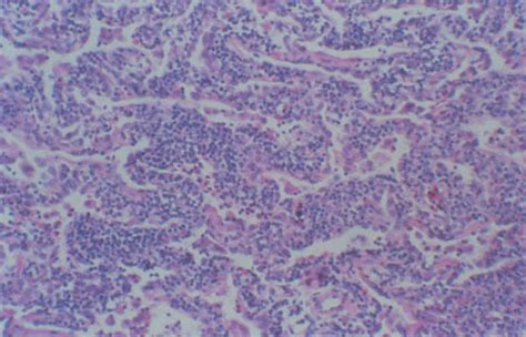VA Clinical Public Health Programs HIV AIDS Lymphocytic Interstitial