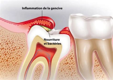 Tout Savoir Sur Les Dents De Sagesse Et Leur Extraction Dentaly Org