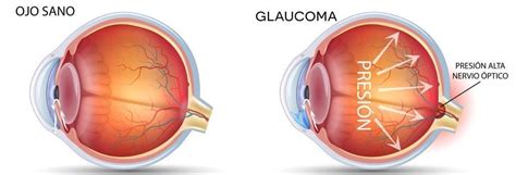 Glaucoma Instituto OMIQ