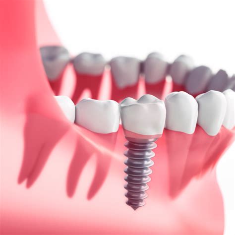 Are Dental Implants Worth The Money Tower Dental