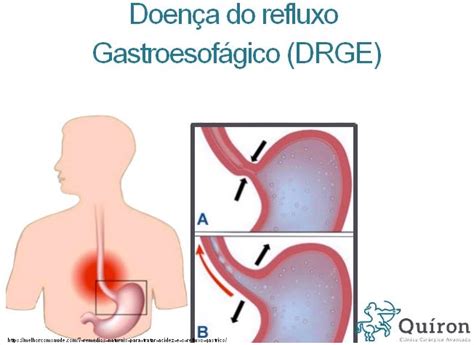 Quíron A doença do Refluxo Gastroesofágico