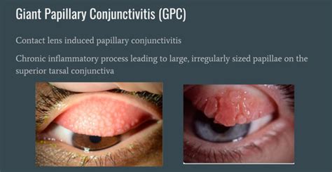 Contact Lens Complications Flashcards Quizlet