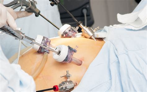 Bypass Gastrico todo lo que necesitas saber Dra Mónica Vera