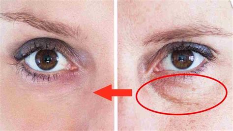 Voici Comment vous débarrasser naturellement des Cernes Sous les Yeux