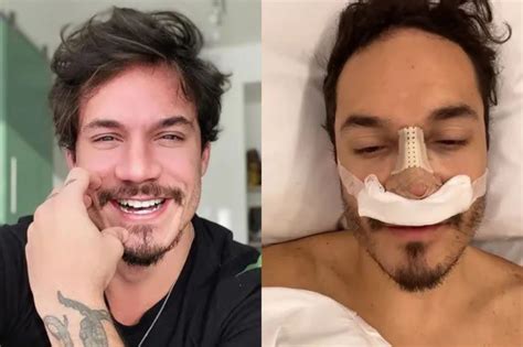 Alta procura de rinoplastia por homens é impulsionado por famosos como