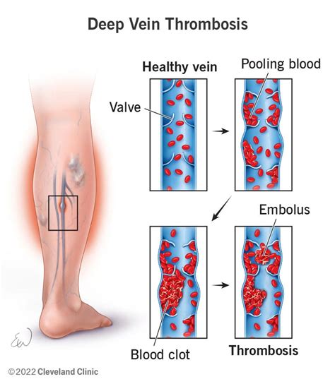 Comprehensive Guide To Deep Vein Thrombosis DVT Atlas Pain Specialists