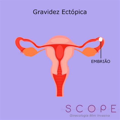Riscos da gravidez ectópica e tratamento via videolaparoscopia