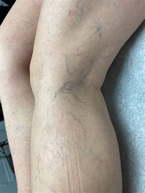 Traitements des varices sclérothérapie Clinique médico esthétique