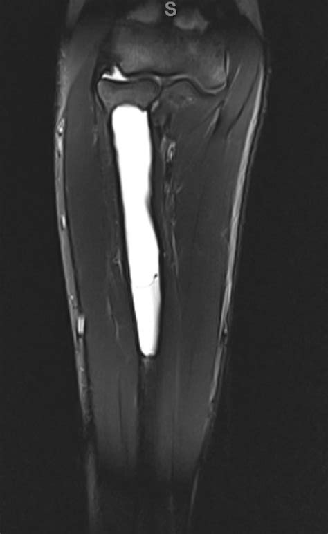 Simple Bone Cyst Radiology Case Radshare Net