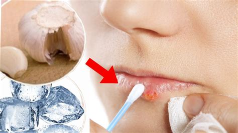 Herpes labial Como curar un herpes labial en 1 solo día Salud Chicas