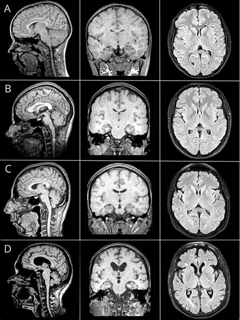 frontiers brain morphometry and cognitive performance in normal brain aging age and sex