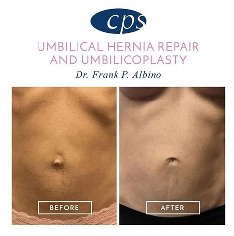 Umbilical Hernia Repair Before And After MEDCOO