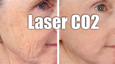 LASER CO2 Fraccionado para ELIMINAR ARRUGAS CLÍNICA VITALIS