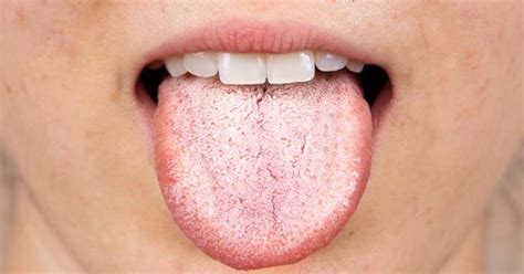 Qué significa tener la lengua blanca y cuáles son los hábitos para