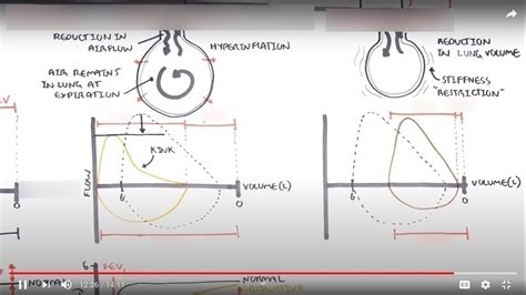 Diagram Of Flow Volume Loops Quizlet