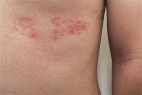 Herpes zoster síntomas y tratamiento