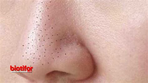Cara Menghilangkan Komedo Di Hidung Tips Efektif Untuk Kulit Bersih