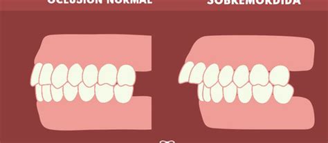 Sobremordida Qué es y Cómo se Trata Clinica Dental Dra Carla Clapes