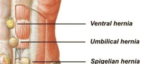 Hernias Flashcards Quizlet