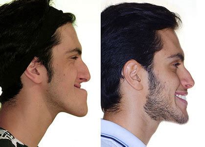 Prog Antes X Depois Homem Dentista Porto Alegre Zona Norte Hera