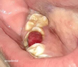 Caries dental Precio reconstrucción dental en Barcelona