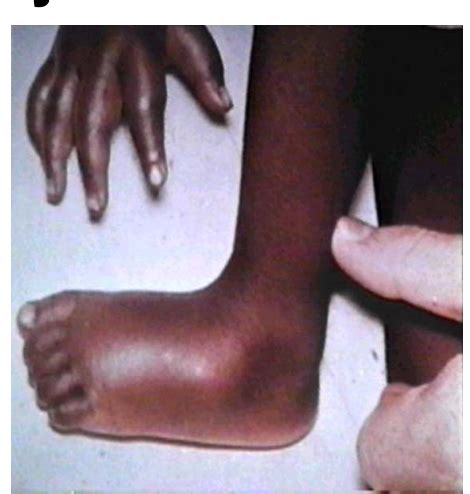 Exam Sickle Cell Anemia Flashcards Quizlet