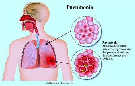 Sintomas De Pneumonia Viral E Tratamento