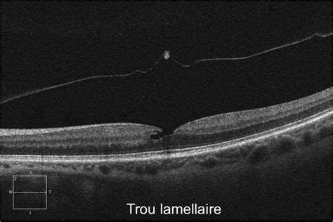 Pathologies Oculaires traitement rétine lyon Centre Rabelais Lyon