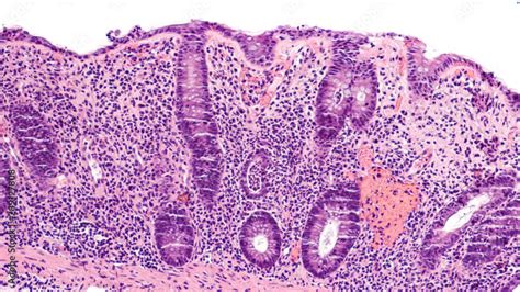 Microscopic Image Of Biopsy Obtained During Colonoscopy From A Patient