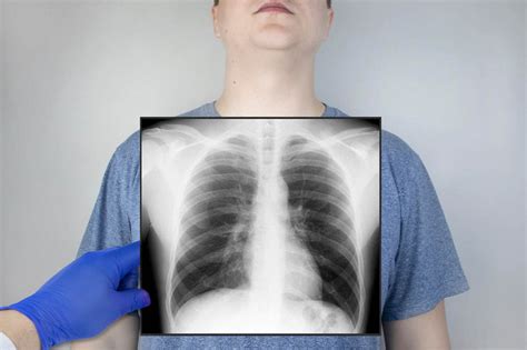 Zachłystowe zapalenie płuc objawy u dzieci i dorosłych